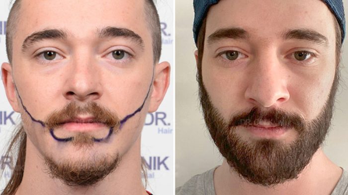 FTM Beard Growth Guide: Methods, Tips, and Personal Experiences ...